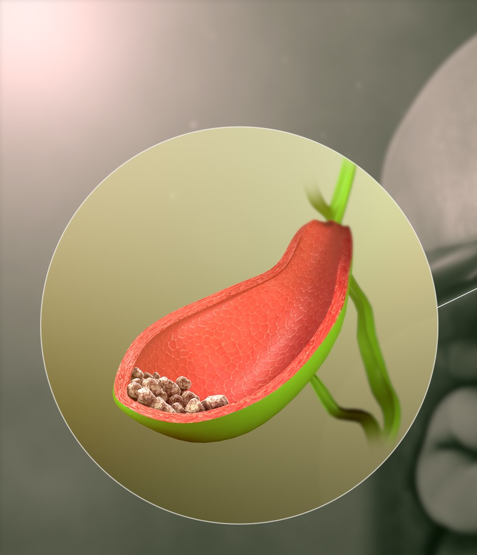 Gallbladder Stones Treatment in Bangladesh | Non-Surgical & Natural ...